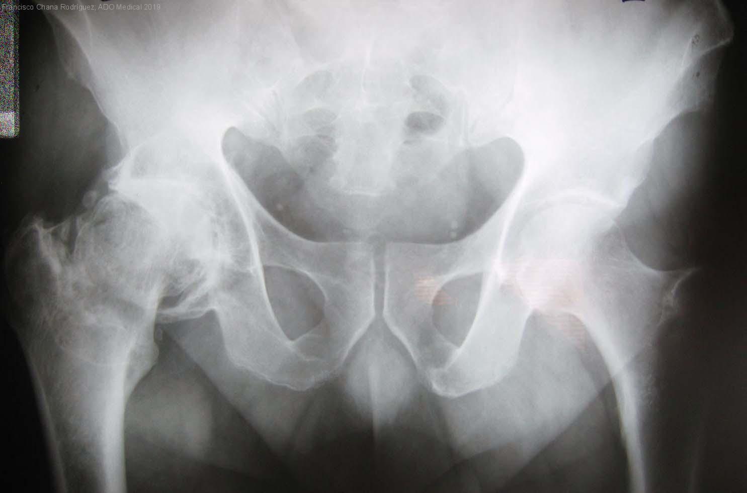 Defecto de planificación preoperatoria en una artroplastia total de ...